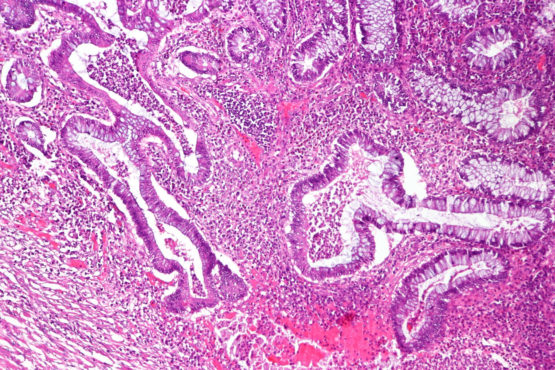 10 Symptoms Of Ulcerative Colitis You Should Never Ignore Huffington News