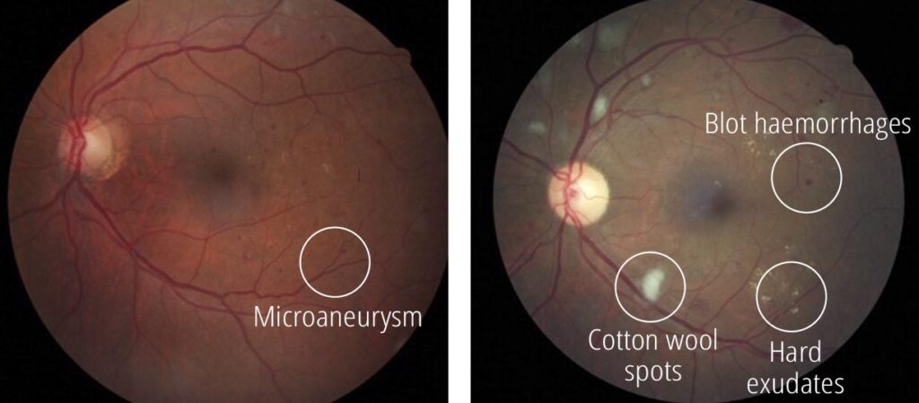 Understanding Proliferative Diabetic Retinopathy Causes Symptoms And Treatment Huffington News